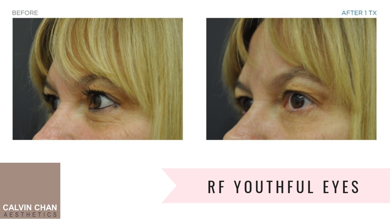RF Youthful Eyes - CALVIN CHAN AESTHETICS