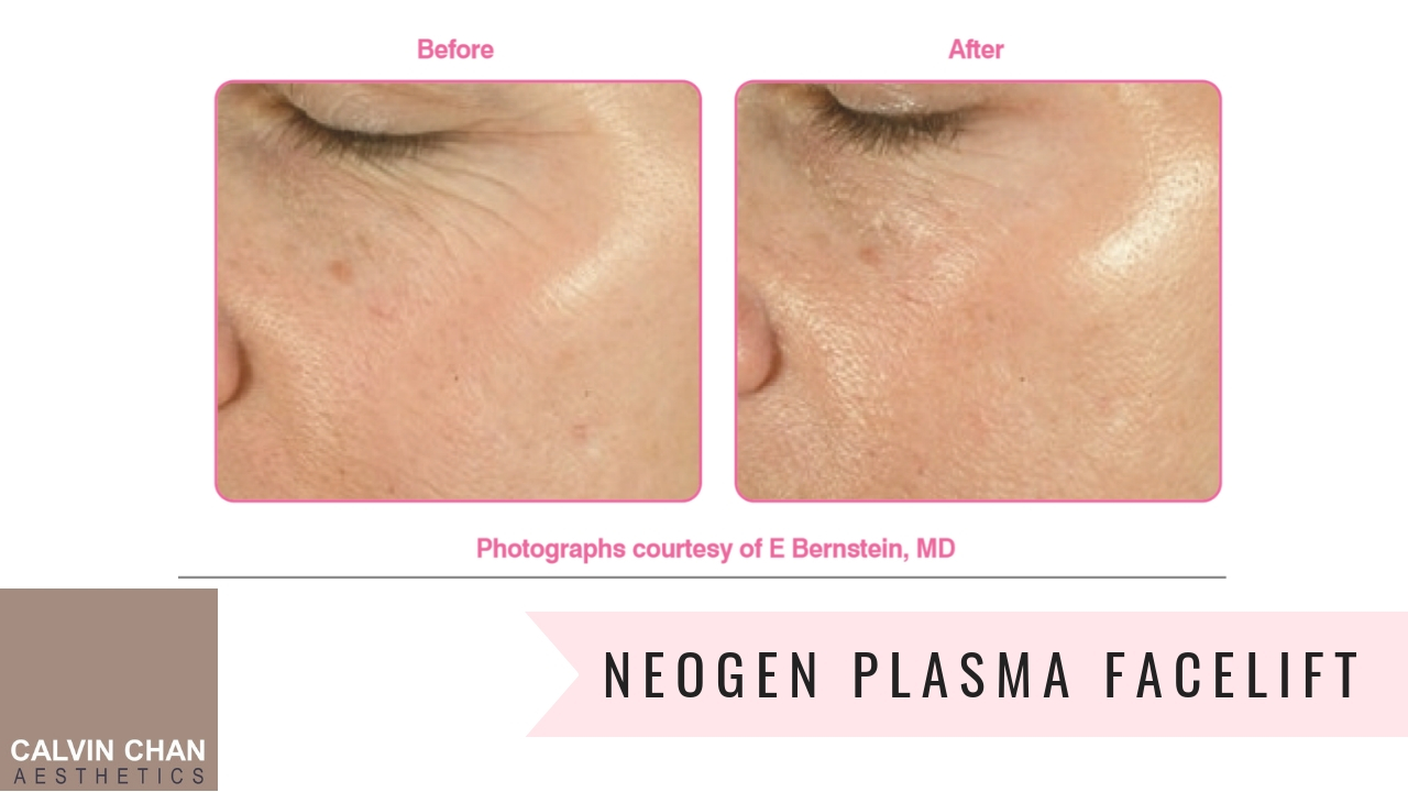 NeoGen Plasma Facelift - CALVIN CHAN AESTHETICS