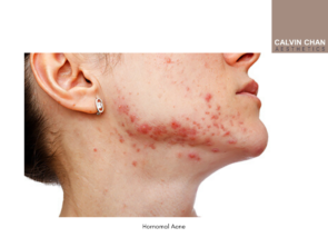 Our complete guide to acne care: How to identify and treat different ...