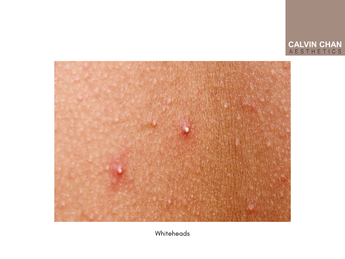 Our complete guide to acne care: How to identify and treat different ...