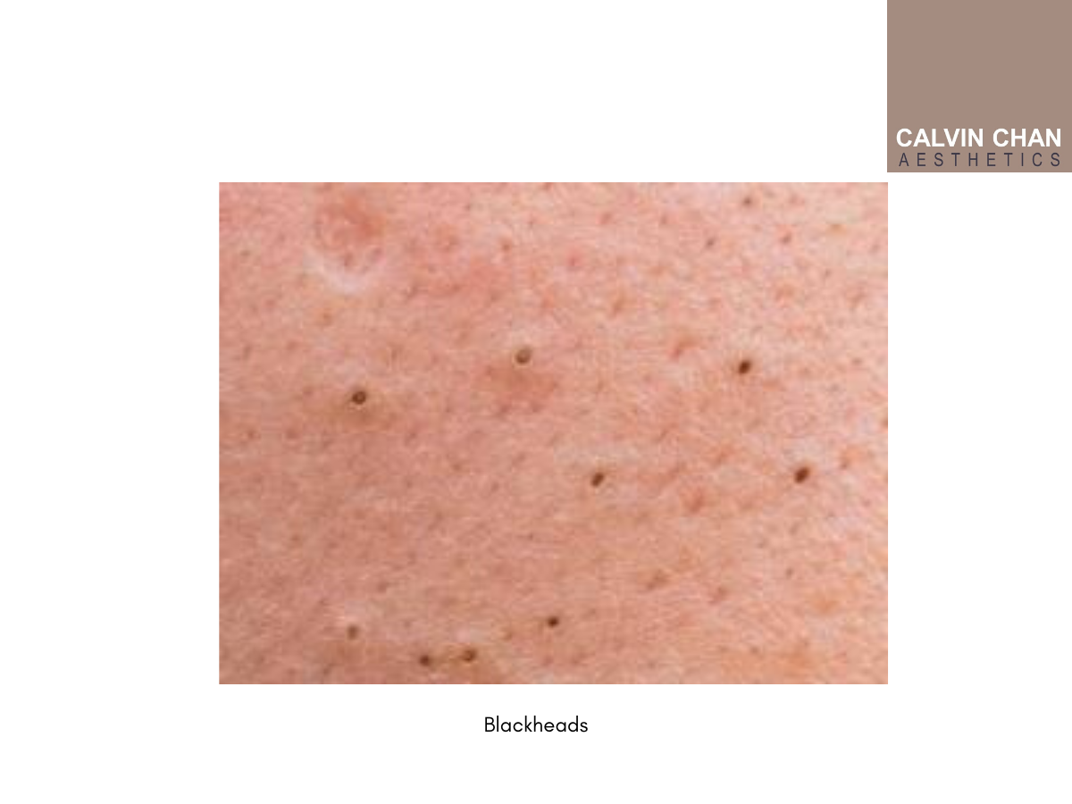 Our complete guide to acne care: How to identify and treat different ...