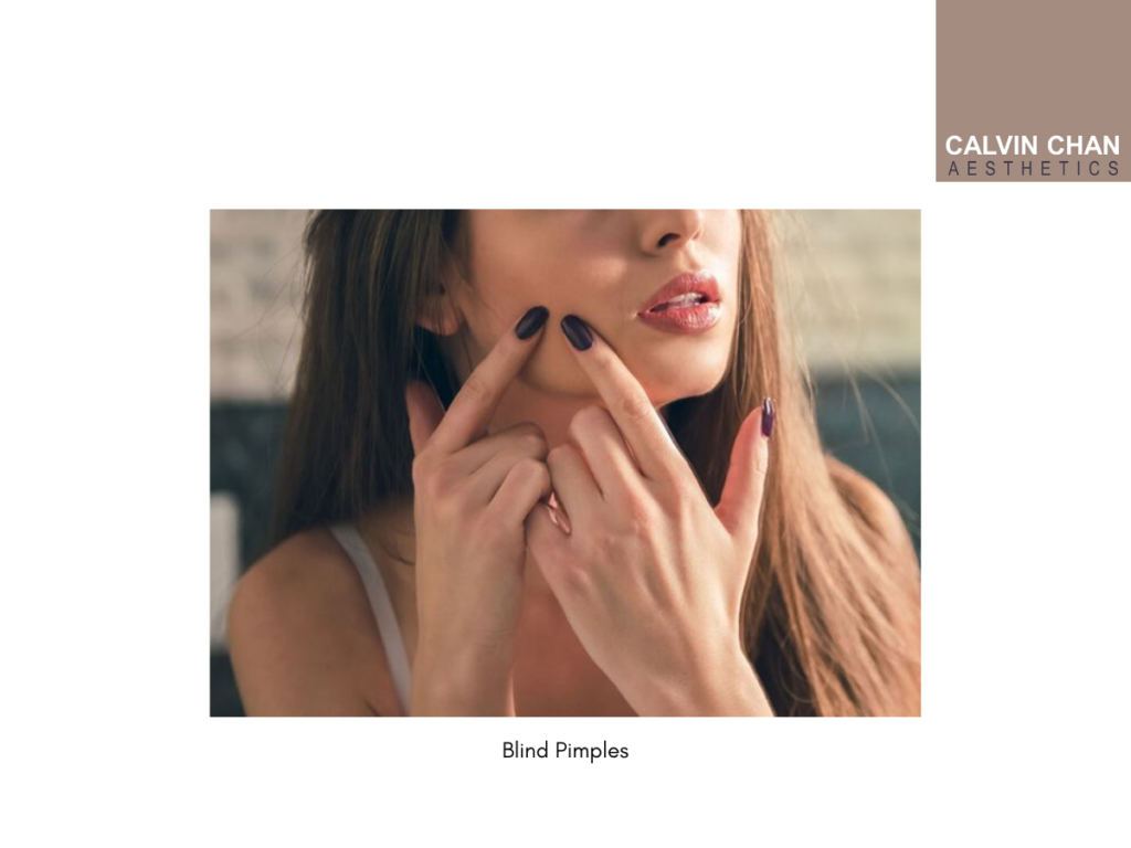 Our complete guide to acne care: How to identify and treat different ...